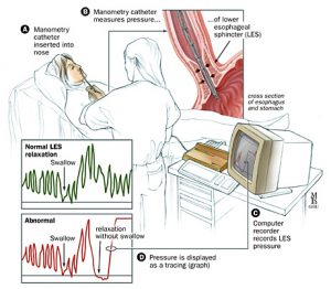 Acalasia esofagea - Dr. Giovanni Quartararo, Chirurgo Generale a Firenze